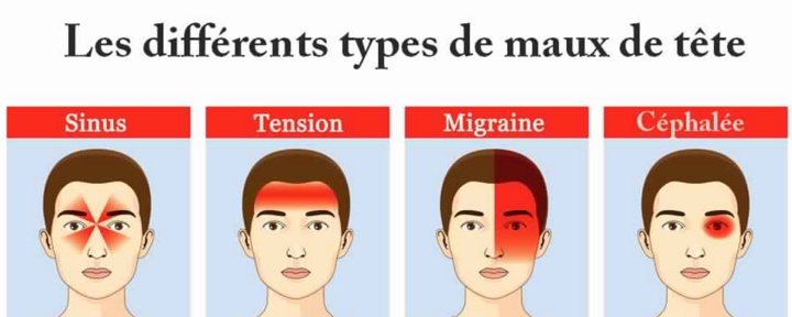 Le type de céphalée que vous avez peut révéler beaucoup sur votre santé ...