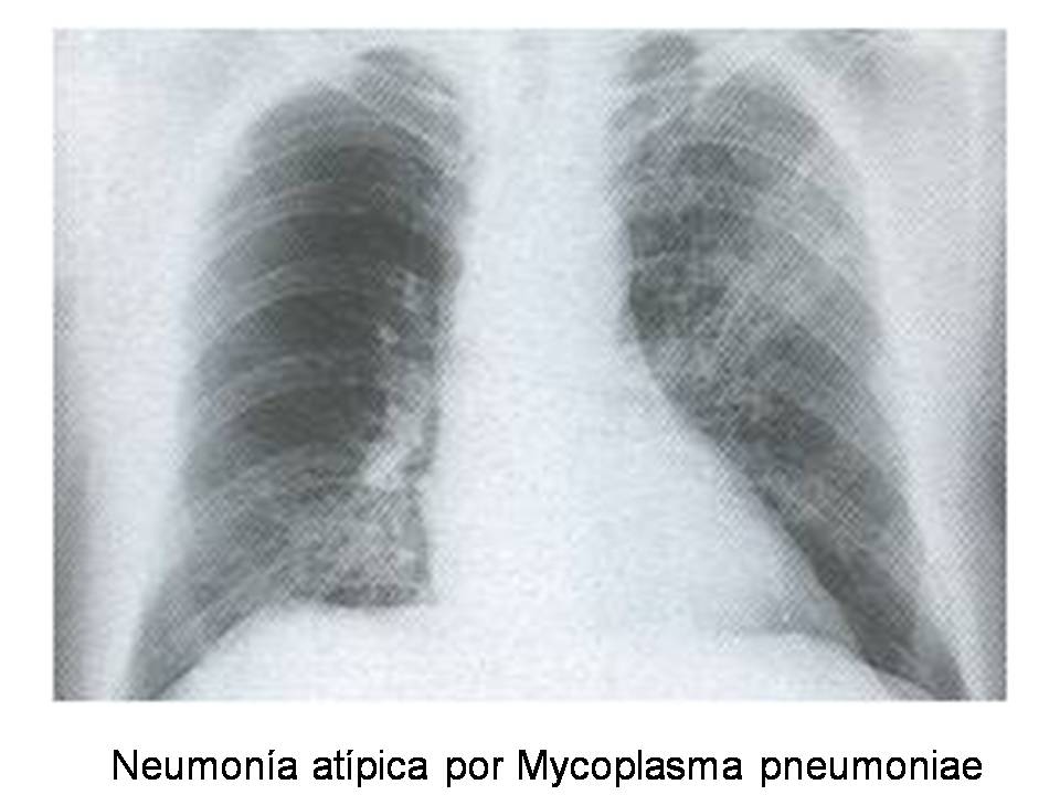 Neumonía adquirida en la comunidad (NAC)