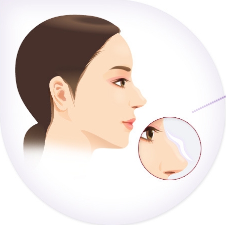 BK Plastic Surgery: [BK Plastic Surgery Hospital]: Nose surgery-Hooked ...