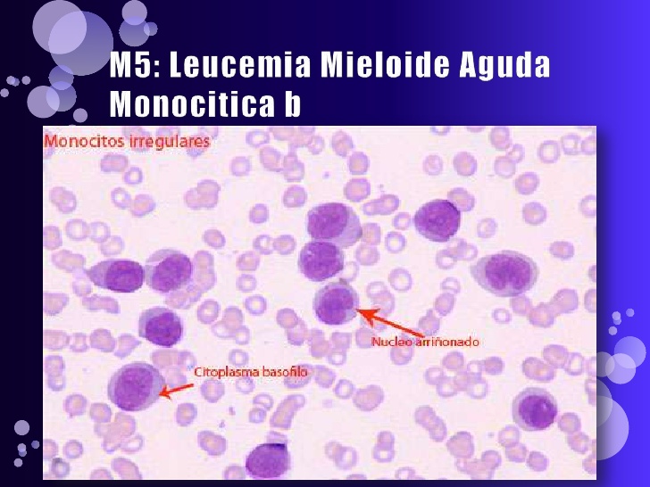 Células Sanguíneas: Leucemias Mieloides Agudas