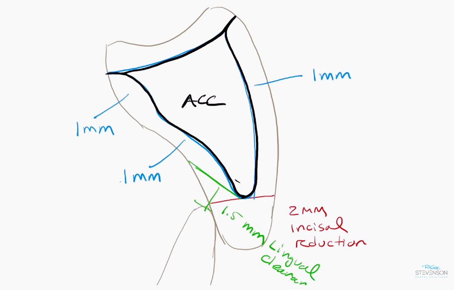 FIXED PROSTHODONTICS: All-Ceramic crown preparation for e.max and ...