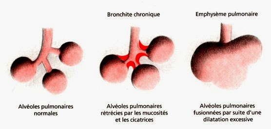 La bronchique chronique | Récap' IDE