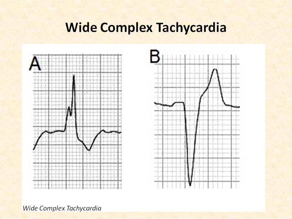 ECG Rhythms: Practical Approach of Wide Complex Tachycardia in Cardiac ...
