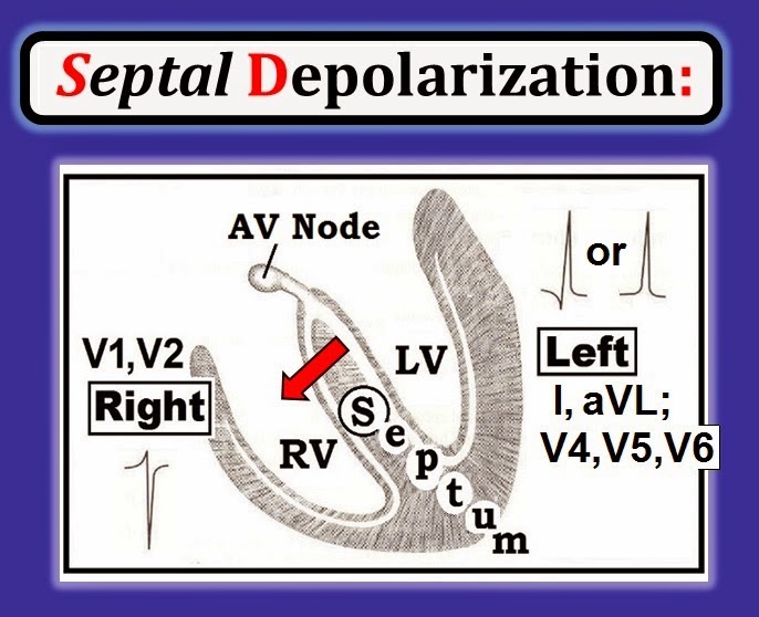 12 Lead EKG Septal Infarct