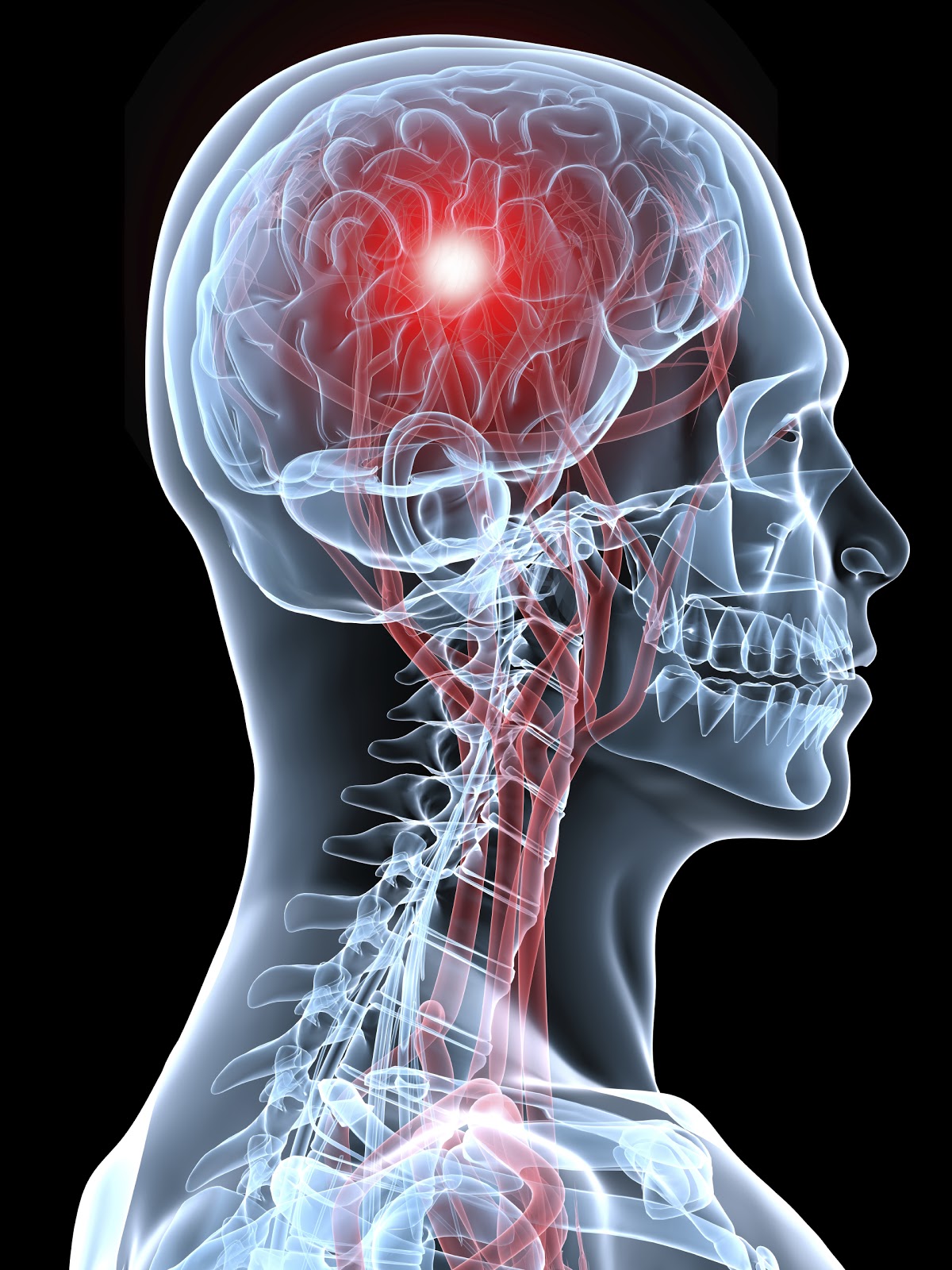 Yogi Wellness Journey Yoga For Stroke Recovery And Prevention