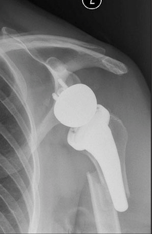 UW Shoulder and Elbow Academy: Periprosthetic fractures following short ...