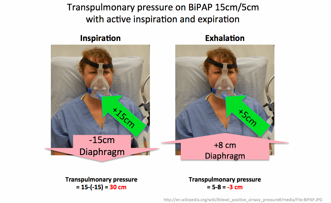 Apneic ventilation using pressure-limited ventilation