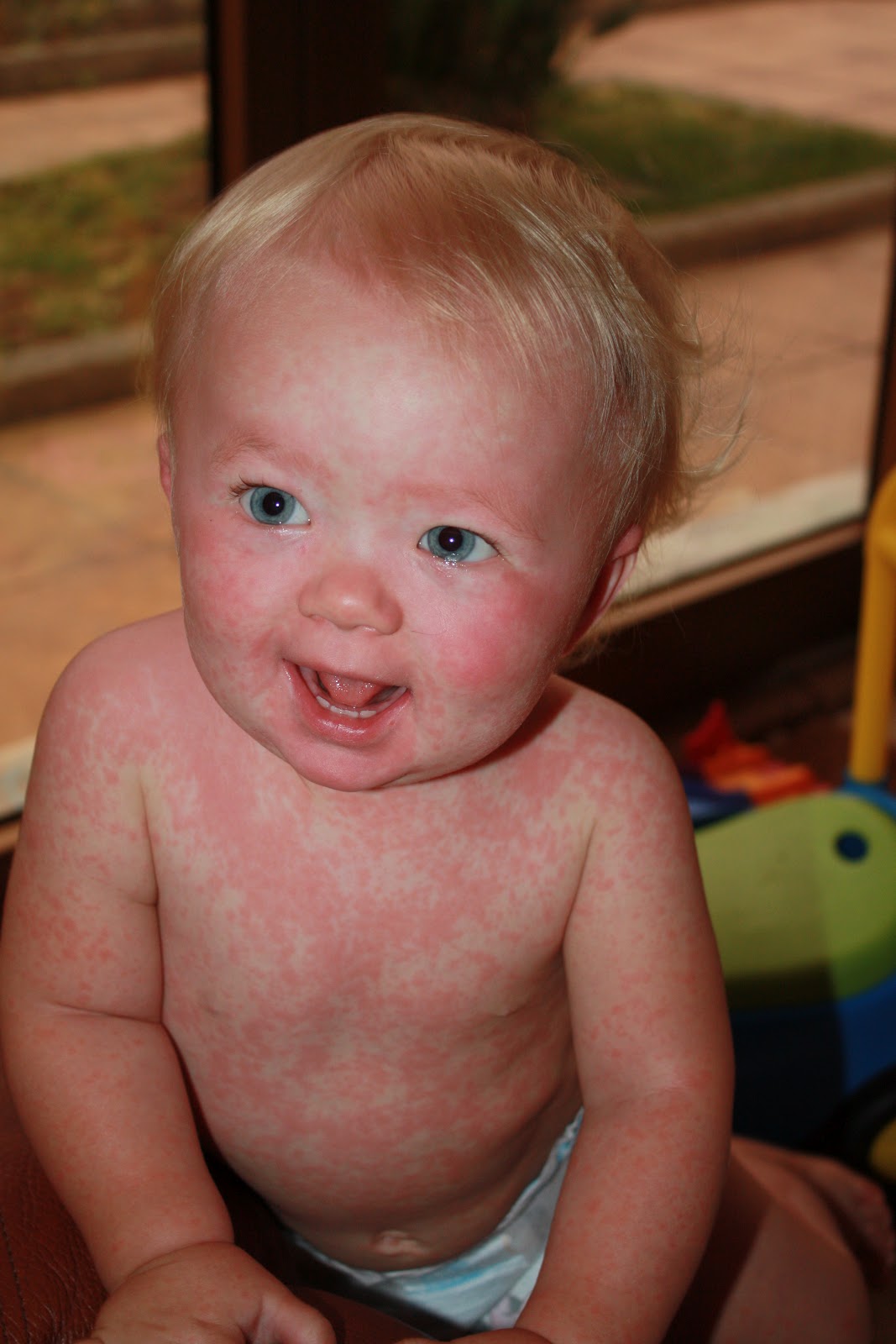 Daily Blog: Diagnosis: Roseola