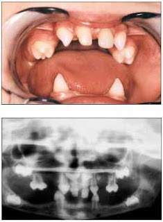 Dentistry lectures for MFDS/MJDF/NBDE/ORE: Dental Anomalies at ...