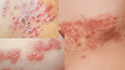 Punca Kayap Dan Cara Mengubatinya Dengan Berkesan | VITAMIN UMMI ZARA ...