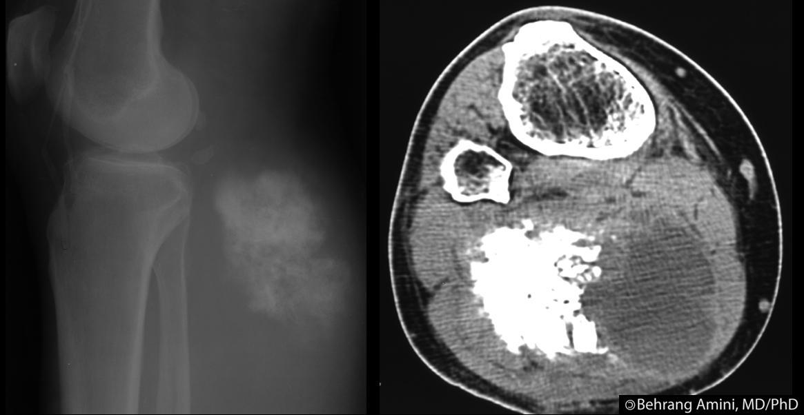 Roentgen Ray Reader: Extraskeletal Osteosarcoma