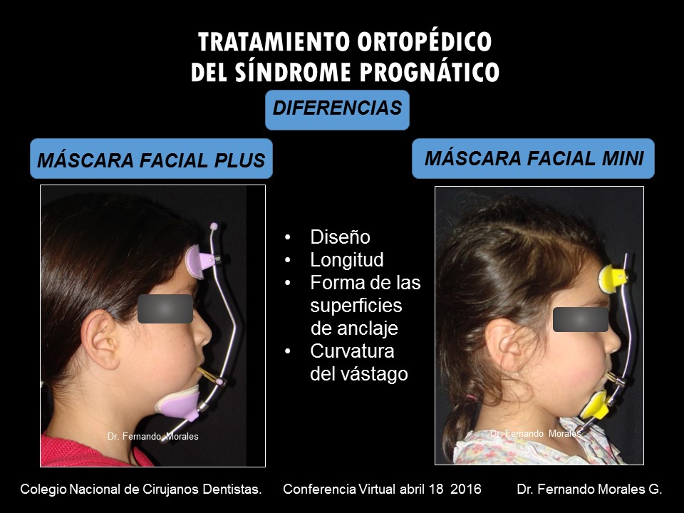 Dr. Fernando Morales Blog: “Tips en protracción maxilar, Máscara Facial ...