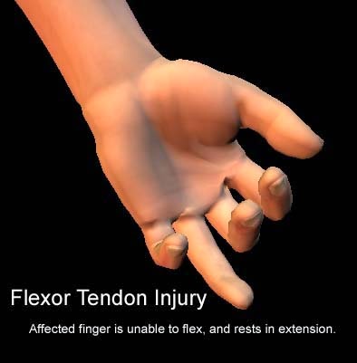 MYO Therapy & Healthcare Institute: Flexor Tendon Injuries