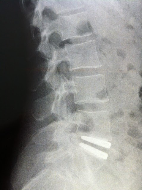 MI PRÓTESIS DE DISCO LUMBAR M6: RADIOGRAFIAS