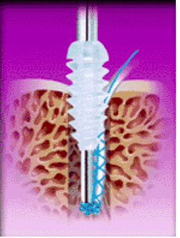 UW Shoulder and Elbow Academy: A loose biceps tenodesis screw ...