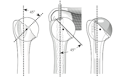 Shoulder Arthritis / Rotator Cuff Tears: causes of shoulder pain ...