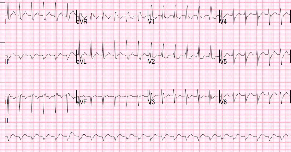 Dr. Smith's ECG Blog: Paroxysmal SVT (PSVT) that repeatedly recurs in ...