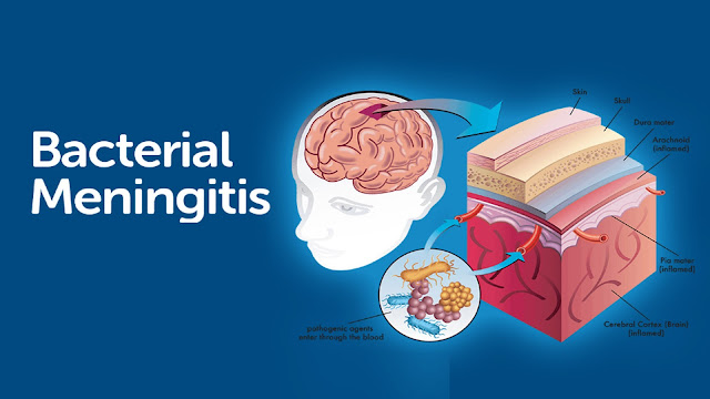 Meningitis Brain Fever Types and Treatment | Education and Information ...