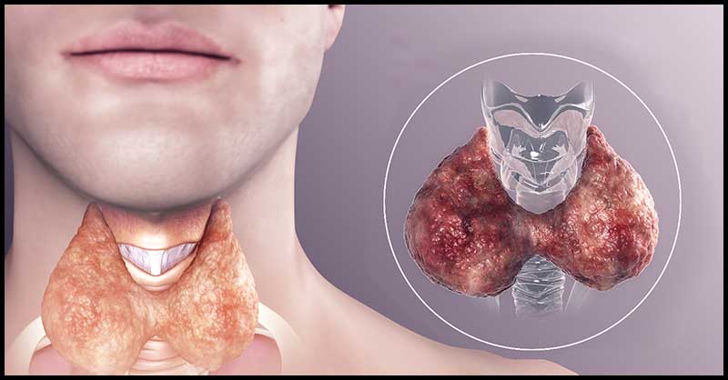 Effective Ways To Treat Hyperthyroidism Naturally | Dr Farrah MD