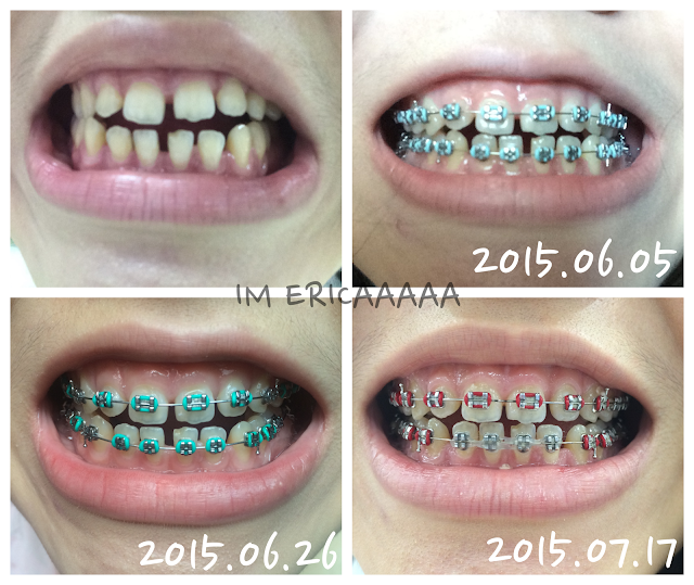 歯｜牙齒矯正一週年紀錄 - eeeee