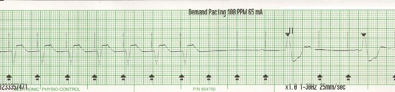 Pediatric External Pacing