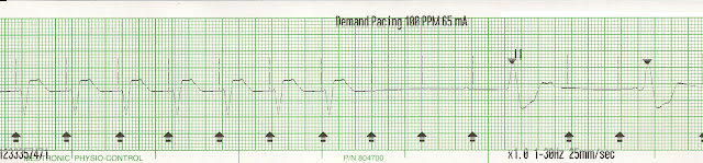Float Nurse: PALS Megacode: Unstable Pediatric Bradycardia Part 4