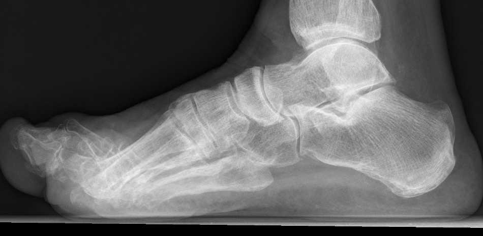 Fanáticos del pie: ATLAS DE PATOLOGÍA DEL PIE: ANTEPIE REUMATICO SEVERO