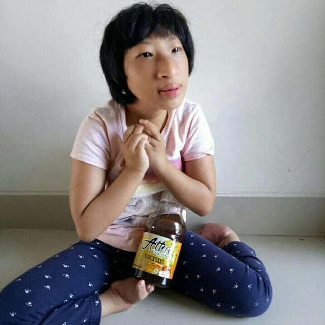 SECKEL SYNDROME, BERPERAWAKAN KECIL TAK LEBIH DARI 100CM - Story Of My Life