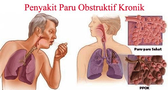 Macam macam penyakit yang disebabkan oleh paru paru : Sehat Itu Penting