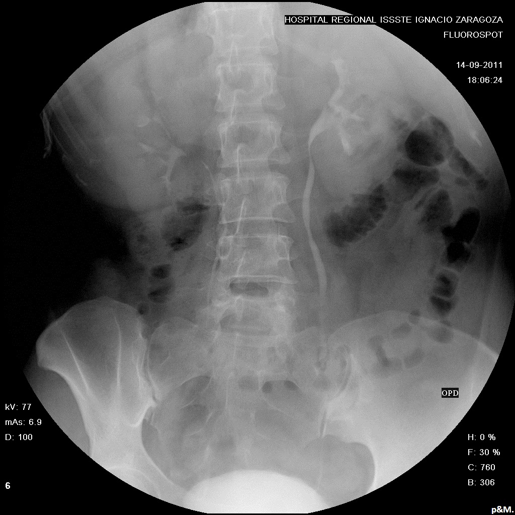 RADIOLOGIA e IMAGEN CETIS 76: UROGRAFIA EXCRETORA