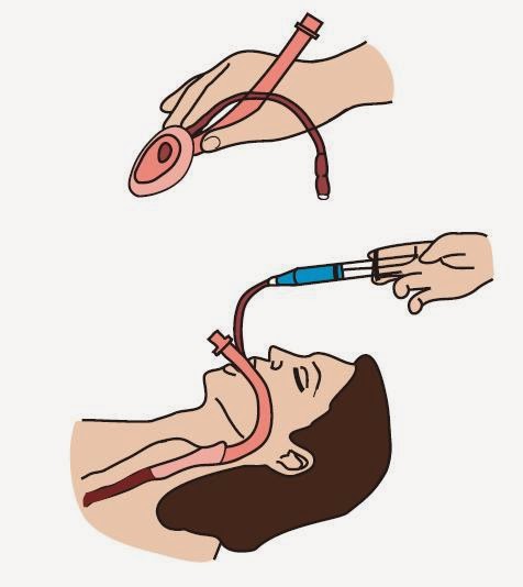 Laryngeal Mask Airway (LMA) ~ Nursing