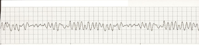 EKG Rhythm Strips 12- ventricular rhythms