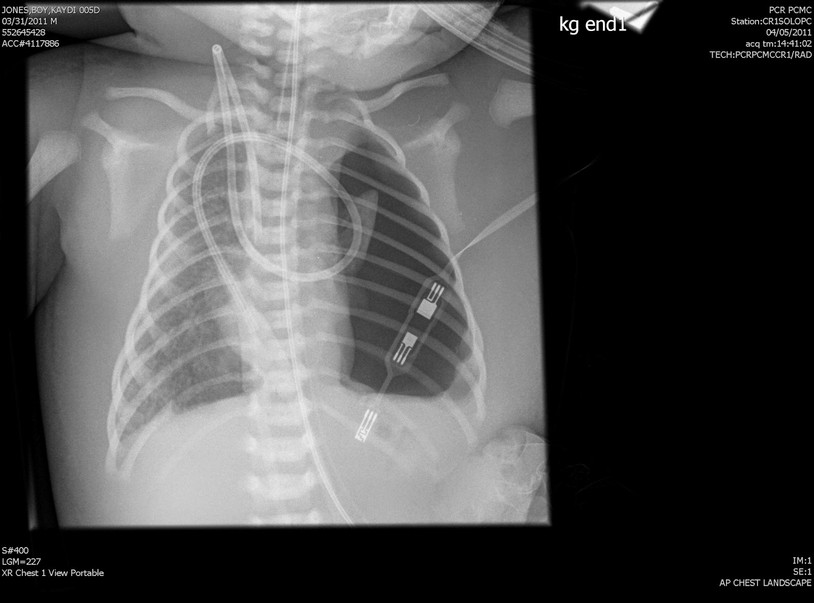 Breath of Hope, Inc. | Congenital Diaphragmatic Hernia Awareness ...