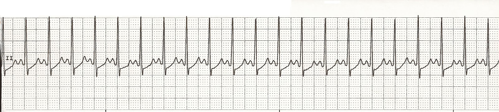 EKG Rhythm Strips 58