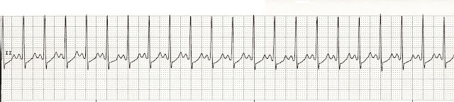 EKG Rhythm Strips 58