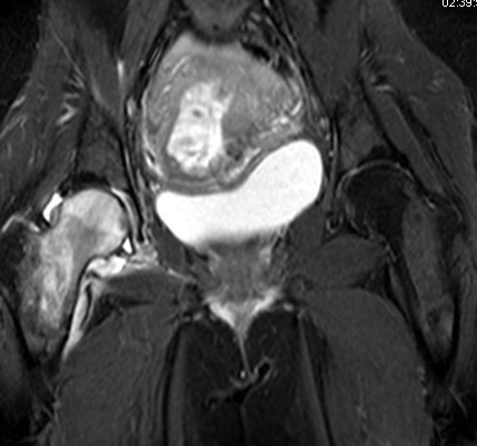 Transient bone marrow oedema of the hip-MRI - Sumer's Radiology Blog