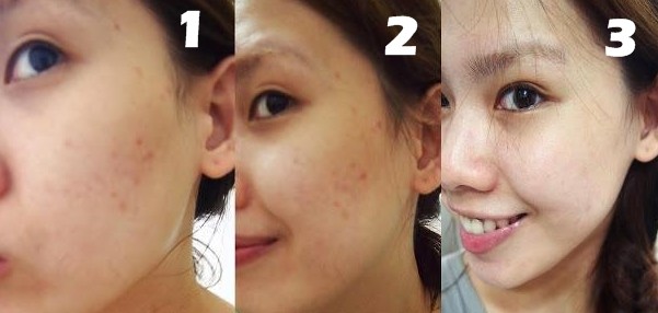 Cara Mempercepat Proses Purging Pada Wajah - Pusat Qnc Jelly Gamat