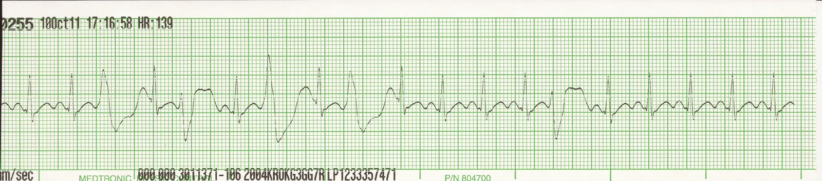 Float Nurse: EKG Rhythm Strips 20: Ventricular Ectopy 3