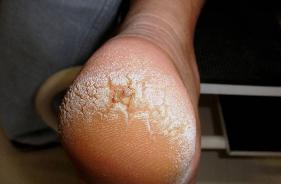 Podologia - saúde dos pés: Calos e calosidades