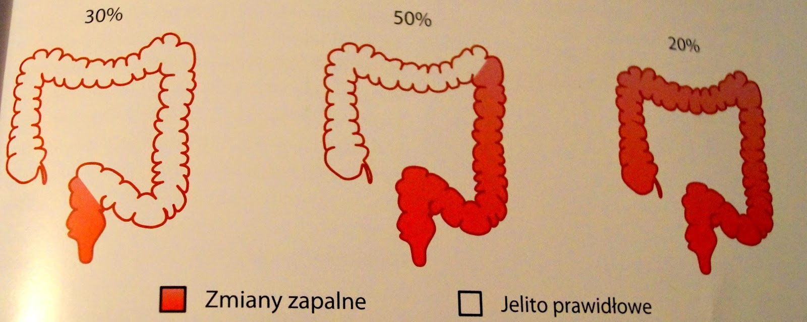CROHNika: lutego 2016