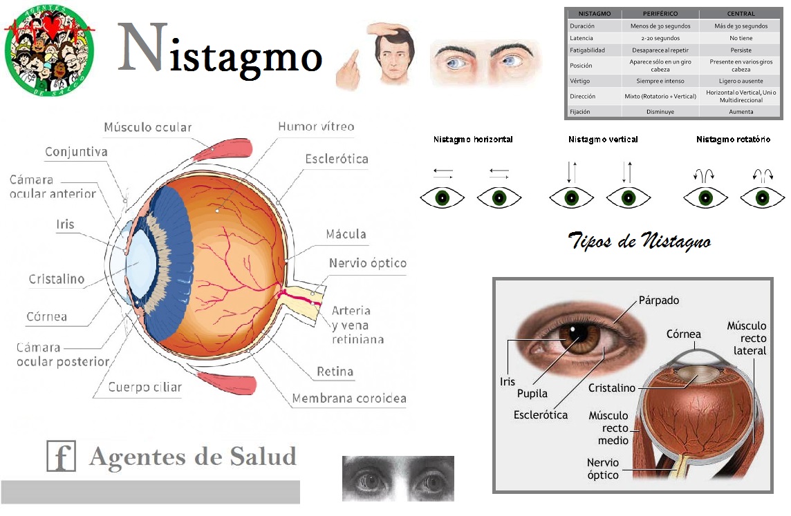 Agentes de Salud: Nistagmo