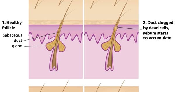 health: what is zits? Its commonplace causes