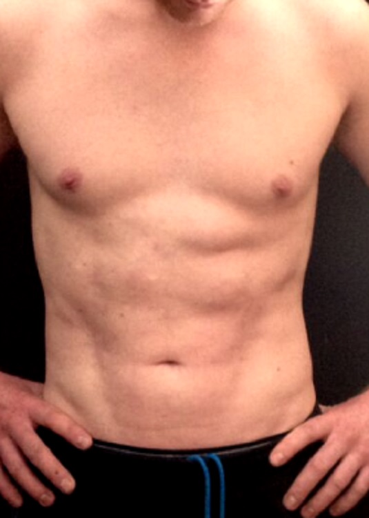 Selston Cosmetic Clinic: Vaser Hi-Def Treatment Before & After Photos ...