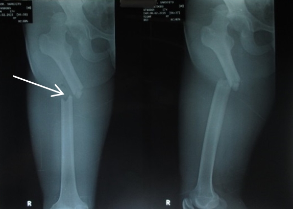 Orthopaedi Knowledges: MANAGEMENT OF LONG BONE FRACTURES