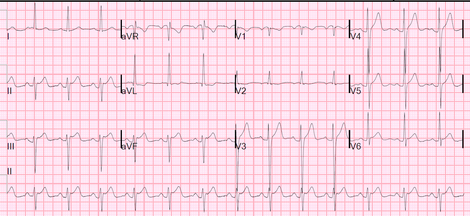 Dr. Smith's ECG Blog: LVH with expected repolarization abnormalities ...