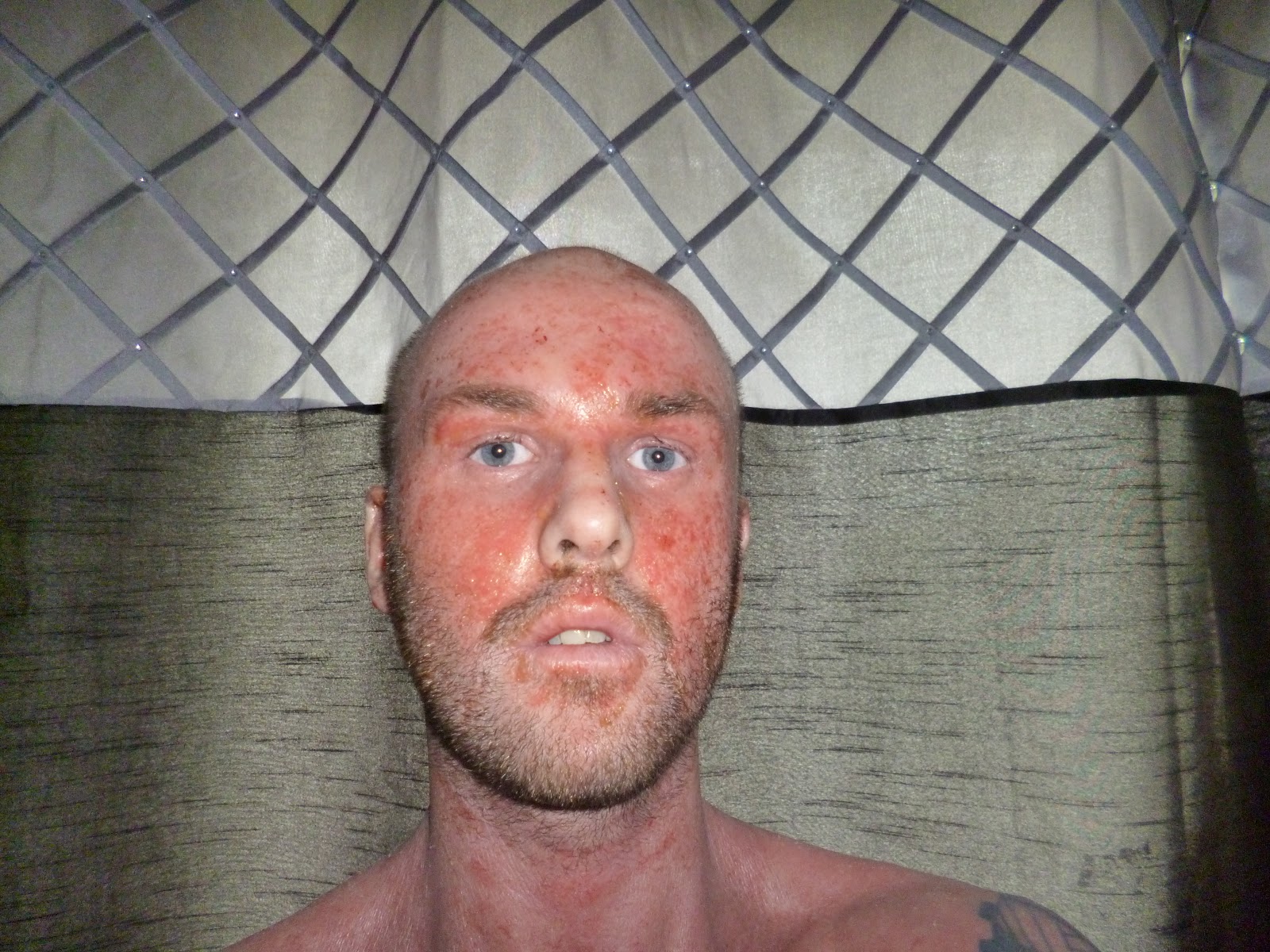 The Age of Skin Liberation - Topical Steroid Withdrawal : TSW Facial ...