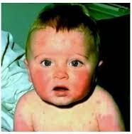 HEALTH AND MEDICINE: FEVERS IN NEONATES, INFANTS, AND CHILDREN