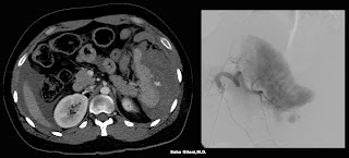 Roentgen Ray Reader: Splenic Injury in Blunt Abdominal Trauma