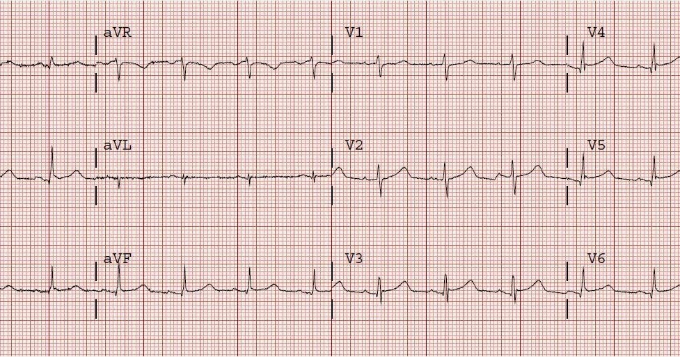 Dr. Smith's ECG Blog: Without reciprocal ST depression or hyperacute T ...