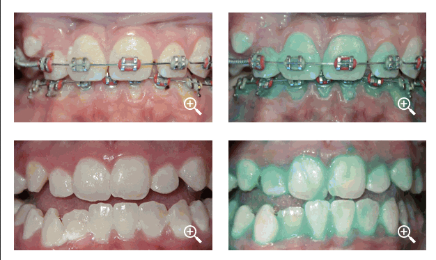 DentaKit.com Products & Tips: Plaque HD Green Toothpaste Reveals The ...